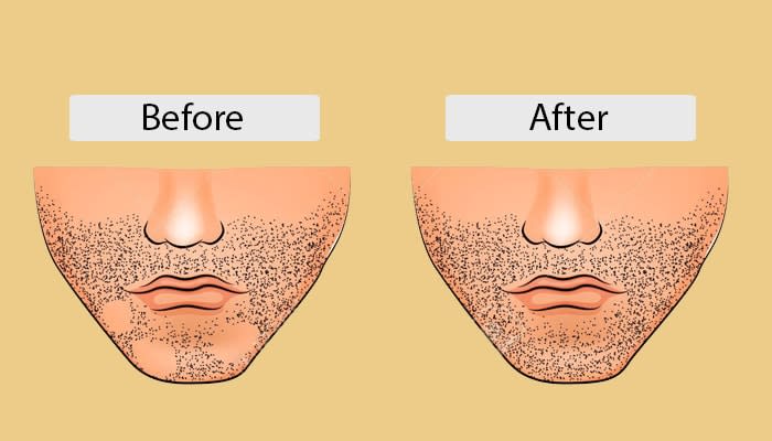 What is Alopecia Barbae And How is it Treated?