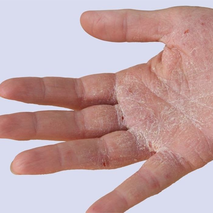Dyshidrotic Eczema On Bottom Of Feet